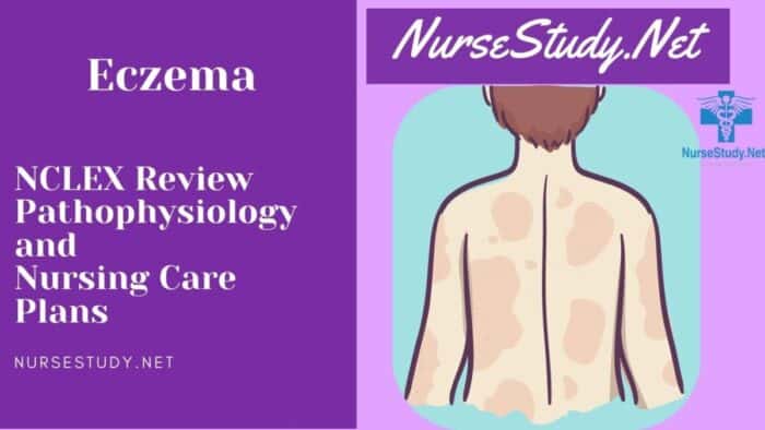 Eczema Nursing Diagnosis & Care Plan - NurseStudy.Net