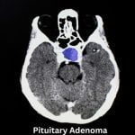 Acromegaly Nursing Diagnosis & Care Plan - NurseStudy.Net